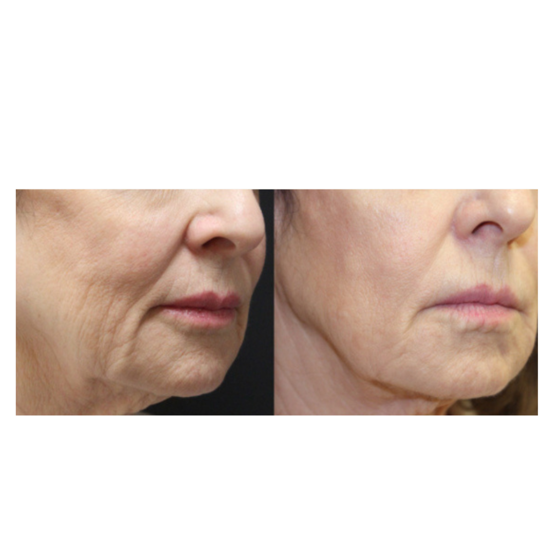 RF SKIN MICRO NEEDLING – ENESIMA